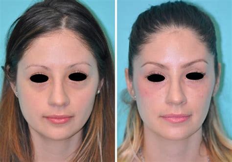 Botox Chevy Chase Botox In Virginia Washington D C And Maryland
