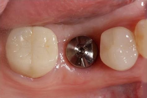 Dental Laboratory Associates Inc Digital Implant Dentistry