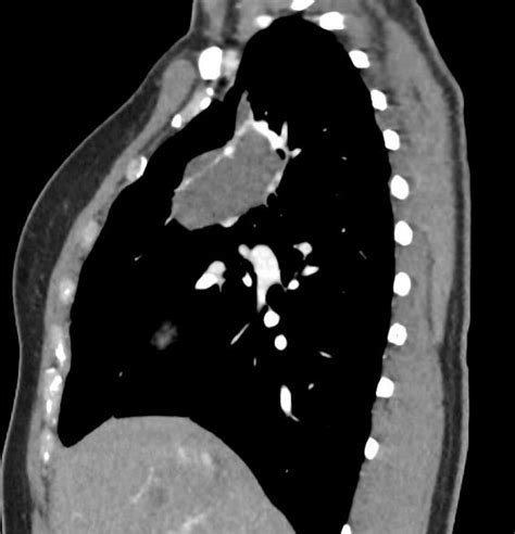Sagittal CT Scan Demonstrating Pulmonary Sequestration In The Right