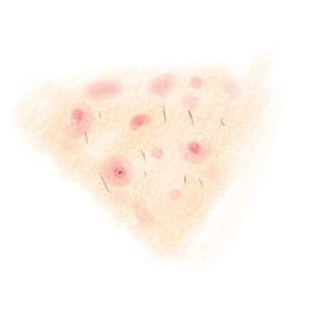 접촉성피부염 대처법 지식in