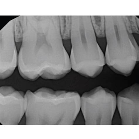 Dexis Titanium Sensor Voxel Dental