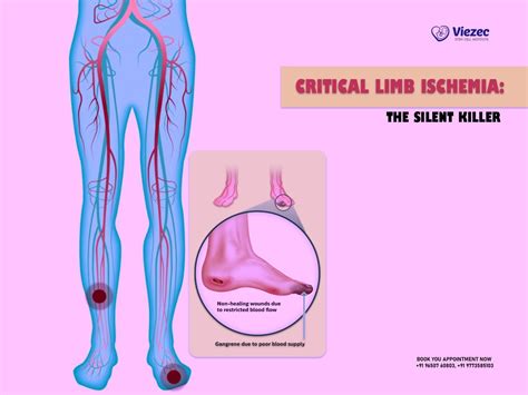 Critical Limb Ischemia The Silent Killer Viezec Stem Cell