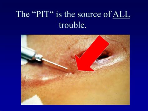 Ppt Failed Pilonidal Surgery Powerpoint Presentation Free Download