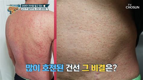 【건선과의 전쟁】 고수의 건선 관리법 공개★ 알맹이 90회 2 Tv Chosun 20200913 방송 Youtube