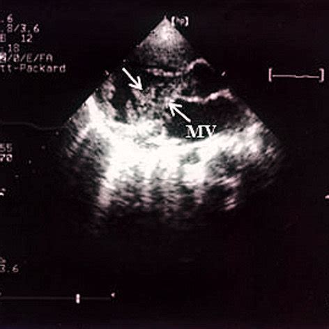 CT Revealed Low Density Imaging In The Left Parietal Temporal Lobe Download Scientific Diagram