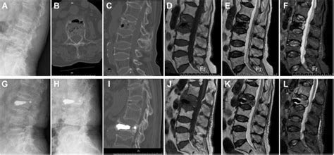 Bone Cement Loosening And Displacement After Traditional PVP In A