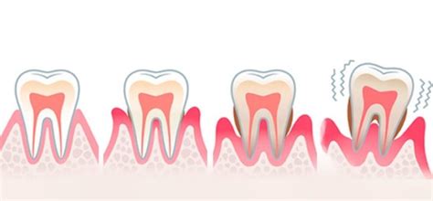 Treatment Of Tooth Mobility My Dentist Toluca Lake