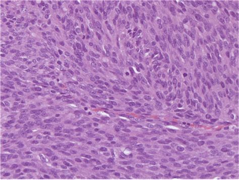 Microscopic Analysis Of The Rectal Gist Tumor Cells Are Spindled