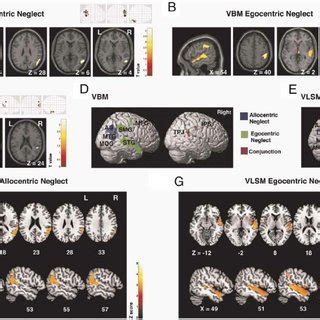 Voxel Wise Statistical Analysis Of White Matter Damage Allocentric