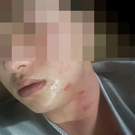 단독 “김하성이 상습폭행”후배 선수 폭행 사진 공개
