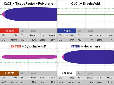 Rotational Thromboelastometry Rotem® Springerlink