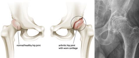 Hip Joint Anatomy And Pathology London Bridge Sports Medicine