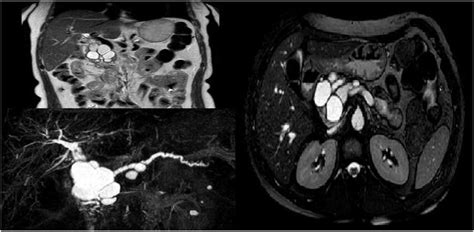 Radiological Features Of A Large Complex Cyst Of The Pancreatic Head