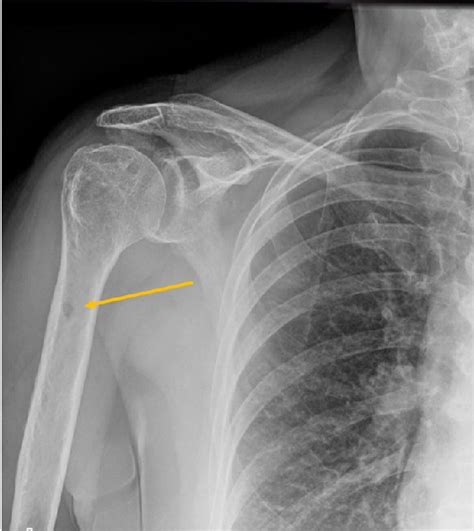 Figure 1 From Intraoperative Periprosthetic Humeral Fracture During