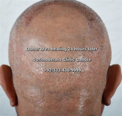 Hair Restoration Recovery