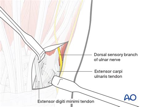 Dorsal Approach To The 5th Carpometacarpal Joint