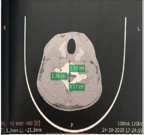 Sagittal Canal Diameter Of 117 Mm And Transverse Canal Diameter Of