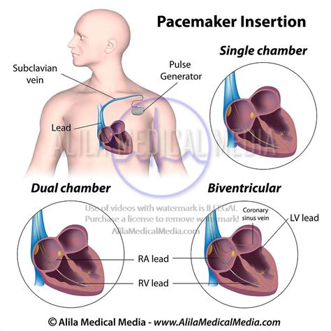 Alila Medical Media Pacemaker Implantation Labeled Diagram