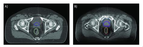 A Planning Ct Scan With Manually Delineated Contours Of Bladder In