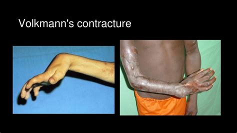 Volkmanns Contracture