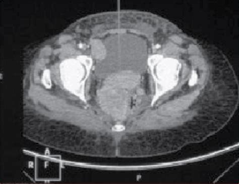 Computerised Tomography Image Of An Irregular Bulky Rectal Mass