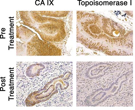 Nanoparticle Based Cancer Therapies Shown To Work In Humans
