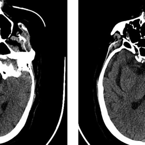 Non Contrast Brain Ct Shows Evidence Of Encephalomalacia And Old