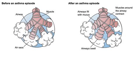 How To Use Your Asthma Inhaler Correctly Mediband Blog