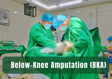 Below Knee Amputation Bka Vl Makabali Memorial Hospital Inc