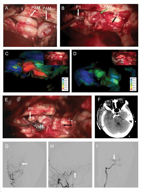 Case 2 Ab Intraoperative Photograph Showing A Right Ica And B