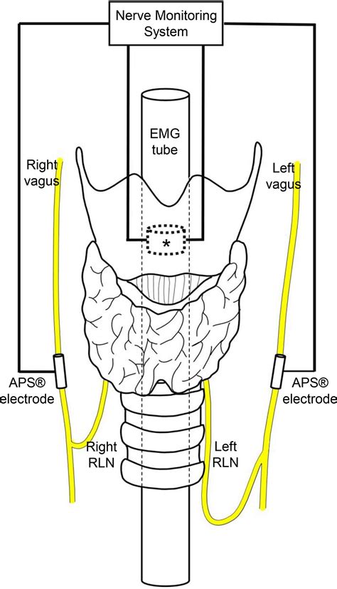 The Learning Curve And Safety Of Continuous Intraoperative Vagus Nerve Monitoring In Thyroid