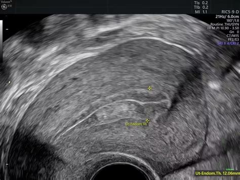 Endometrial Hyperplasia Hyperexcision