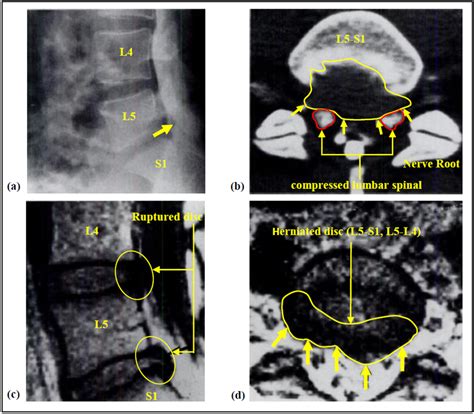 Figure 37 Standard Profile Of The Lumbar Sacral Spine Radiograph Of A