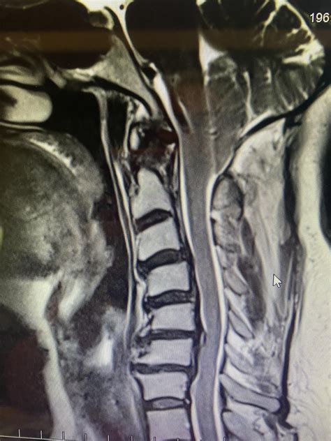 10 Months Post Op Mri After Decompression Surgery I Dont See A Big