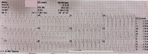 Lbbb Ecg Guru Instructor Resources
