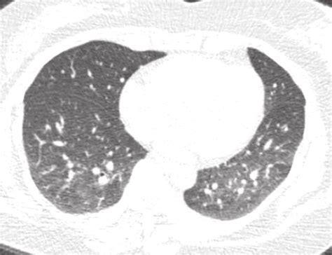 Axial Ct Image In A Non Smoking Physiologically Normal Subject Where