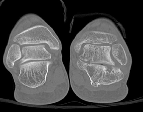 Semi Coronal Calcaneus Ct Scan Of A 39 Year Old Male Patient Shows Loss