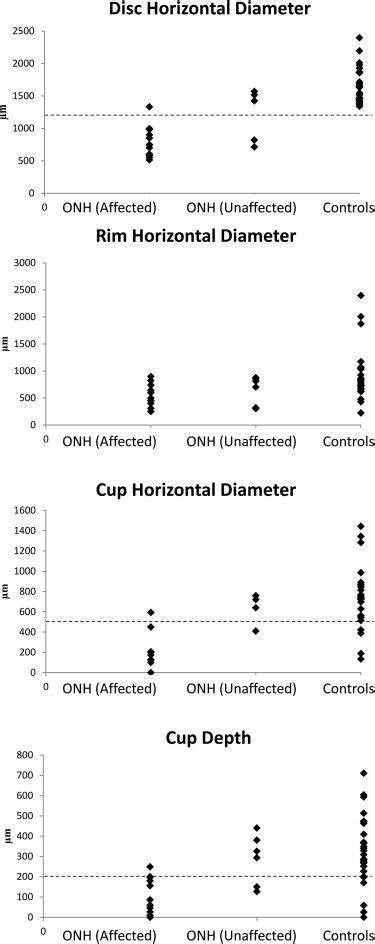 distribution of optic nerve head parameters μm in patients with optic