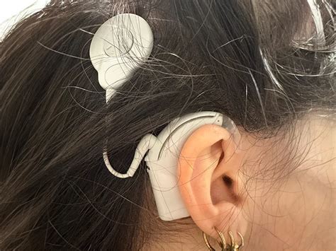 See A Cochlear Implants Specialist Clarity Hearing Of Texas