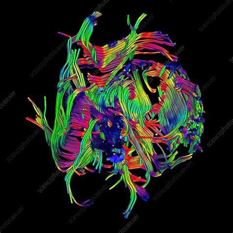 Brain Tumour DTI Scan Stock Image C Science Photo Library