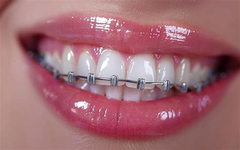 A Woman With Braces On Her Teeth Showing The Teeth Premium Ai