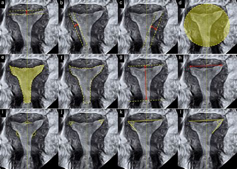 Congenital Uterine Malformation By Experts Cume Diagnostic Criteria For T‐shaped Uterus