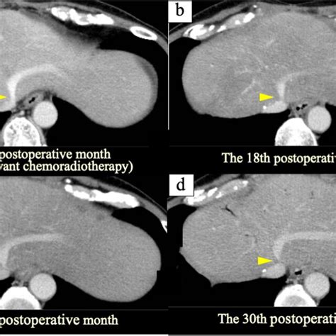 multidetector row computed tomography findings of the gradual narrowing