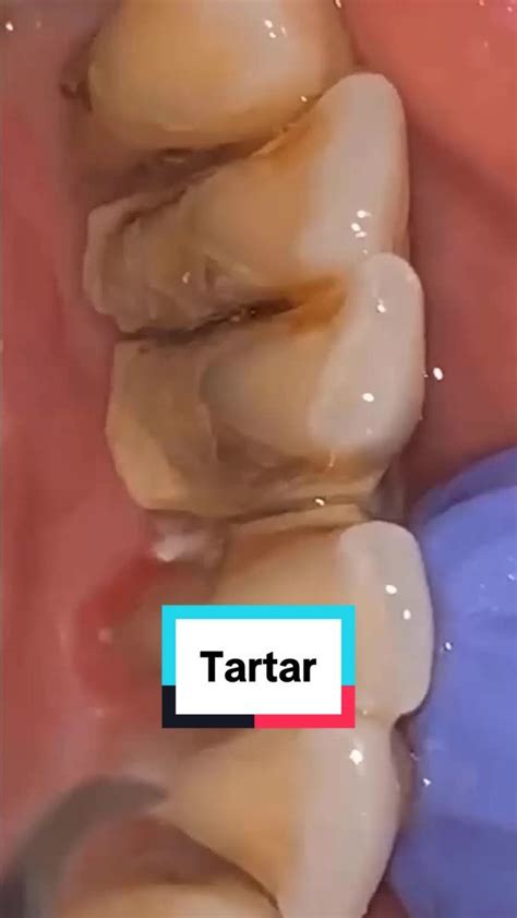 Methods For Cleaning Tartar From Teeth Artofit