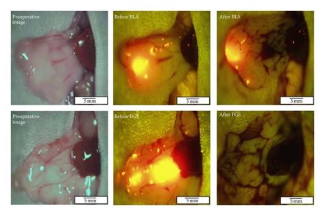 Surgical Resection After Fluorescence Guided Surgery Fgs A The Top Download Scientific