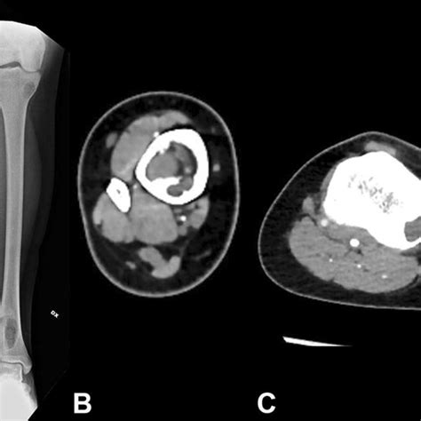 Fungating Tumour With Active Bleeding From The Erosion Download