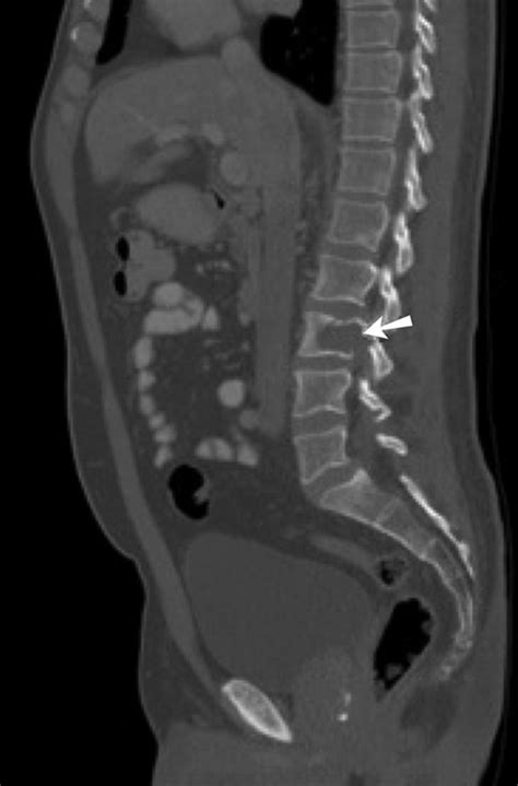 Sagittally Reformatted Ct Image In A Bone Window Shows A Central Lytic Download Scientific