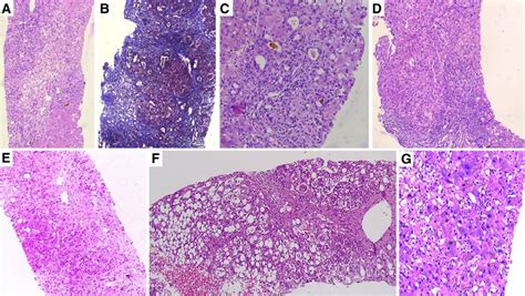 Liver Histopathology Of Chronic Liver Disease Patients With Ayurvedic