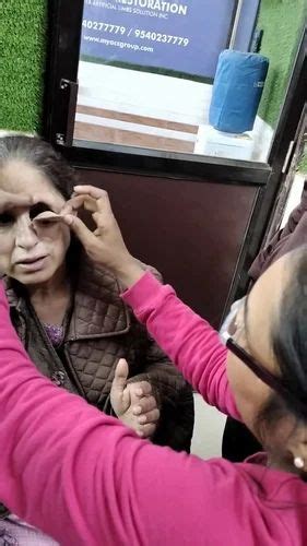 Silicone Eyes Prosthesis At Rs 22328 Artificial Eye In Ghaziabad Id