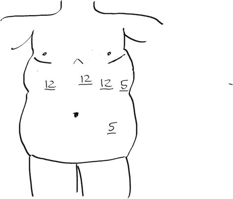 Revision Surgery Port Position Port Positions Analog To The Initial